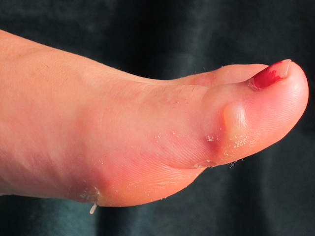 Blisters on Feet | Med-Health.net