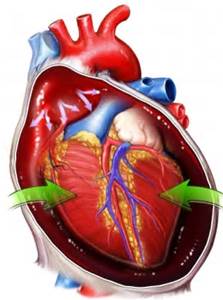 Cardiac Tamponade | Med-Health.net